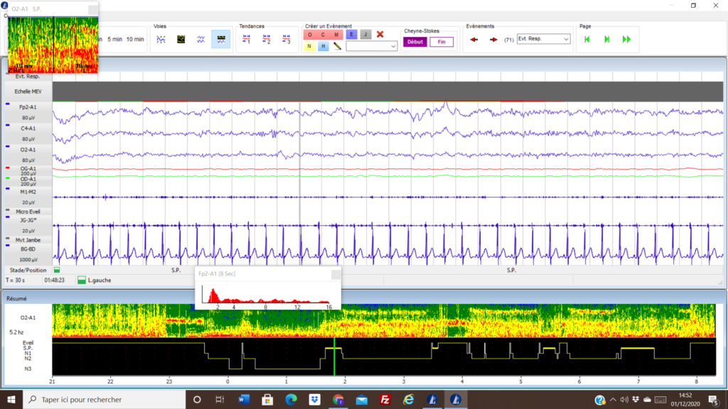 polysomnographie – Réseau Morphée